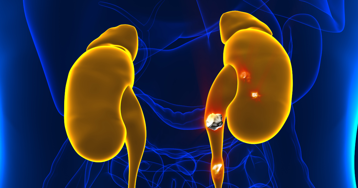 Are Calcium Oxalate Kidney Stones Preventable?