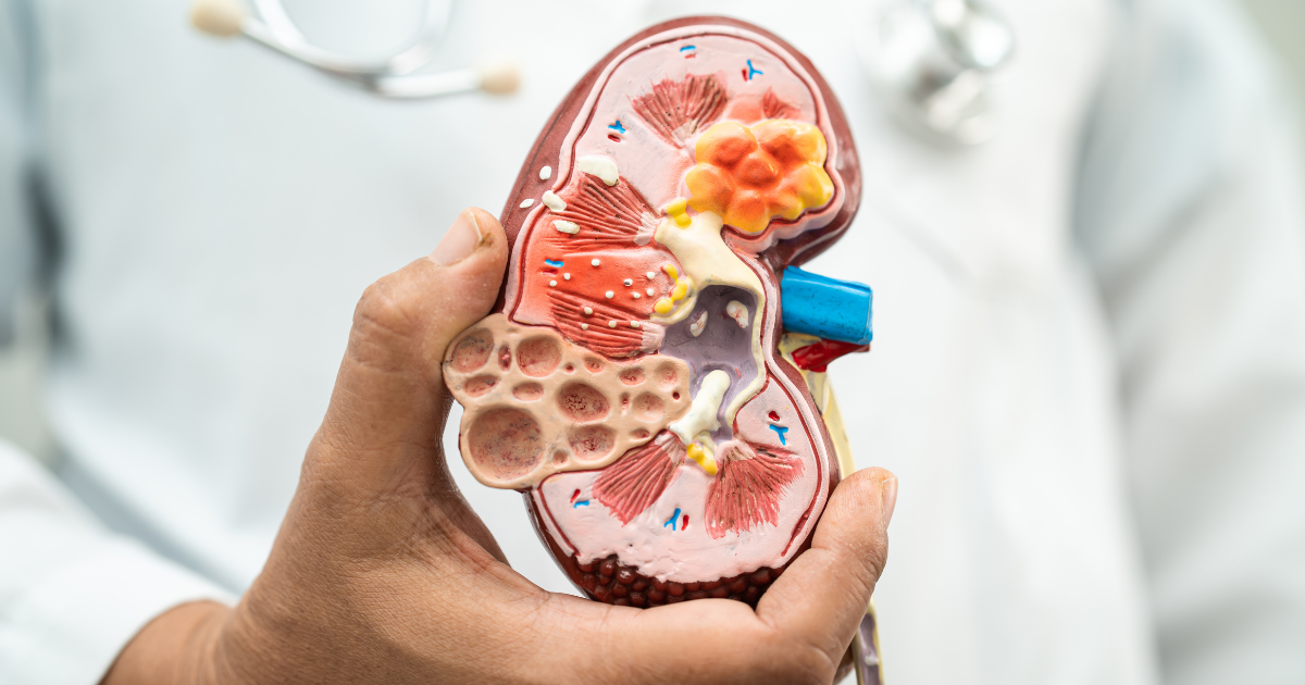 Understanding Stage 4 Chronic Kidney Disease